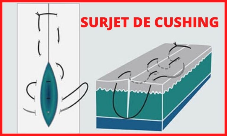Suture chirurgical : Types, technique, Materials - infirmier pro