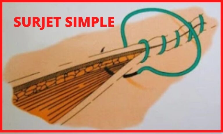 Suture chirurgical : Types, technique, Materials - infirmier pro