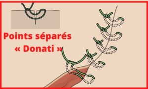 Suture chirurgical : Types, technique, Materials - infirmier pro